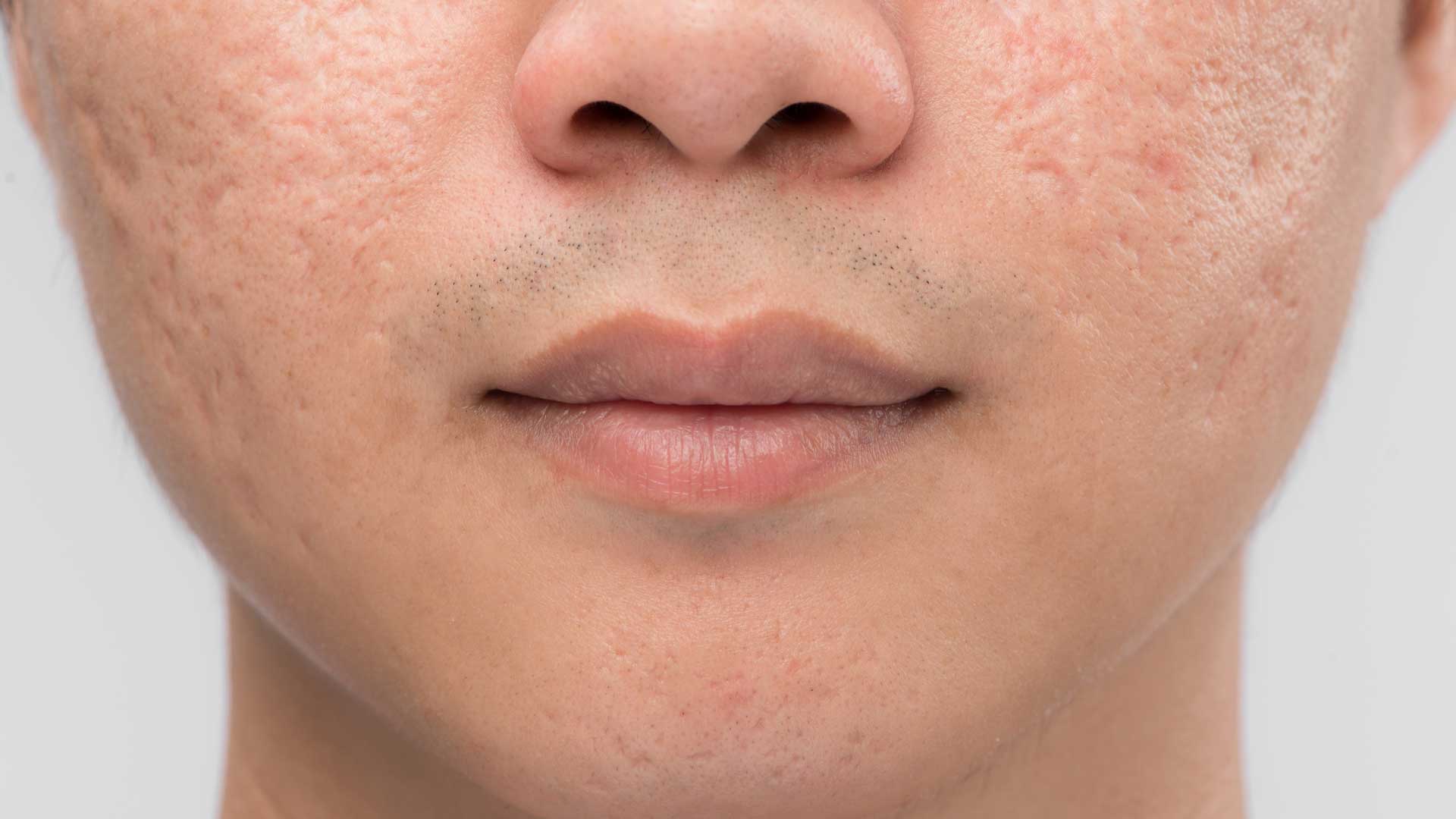 Hvad er Akne og hvordan behandles det - Shjé CPH